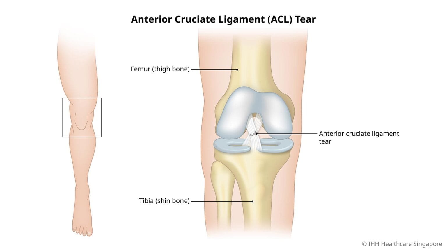 ACL and MCL Injuries: An In-depth Examination of Symptoms and ...